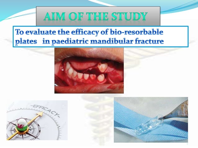2 bio resorbable plates as effective implant in pediatric mandibular ...