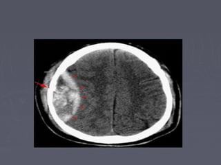 2- Brain emergency | PPT