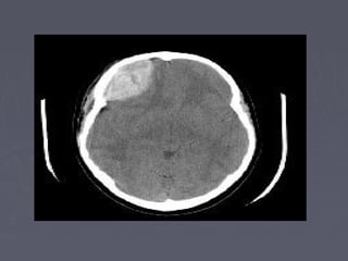 2- Brain emergency | PPT