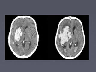 2- Brain emergency | PPT