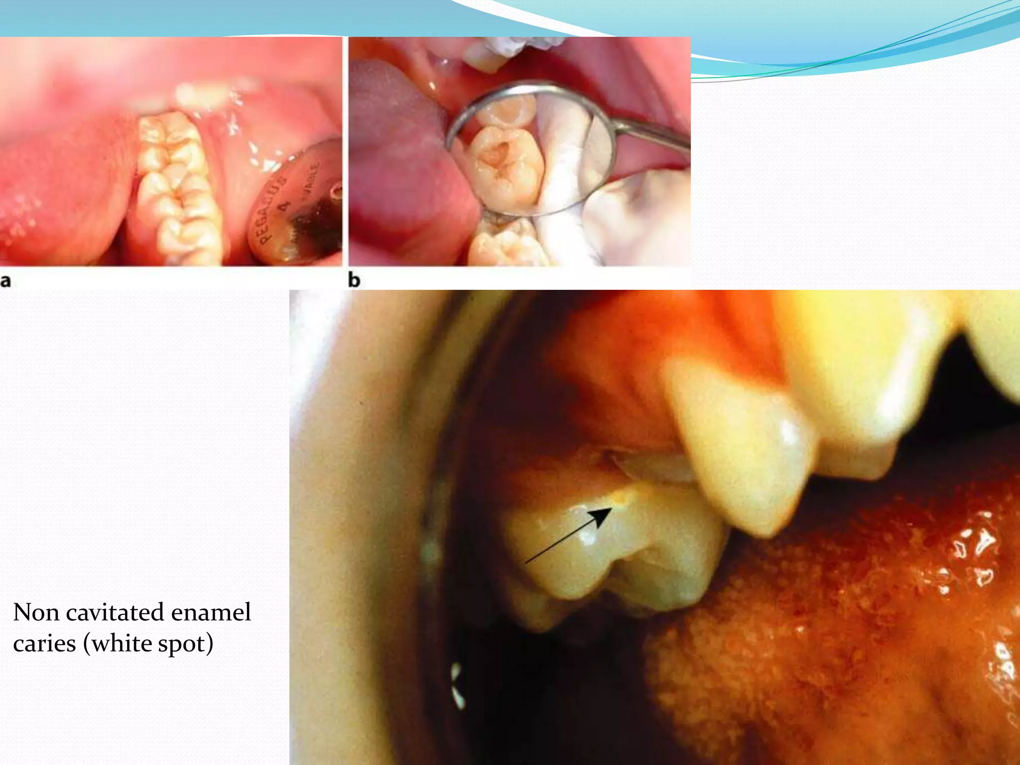 2-Caries diagnosis+prevention.pptx