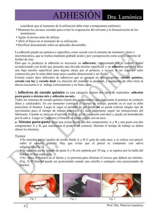 2 Cementado de Brackets | PDF