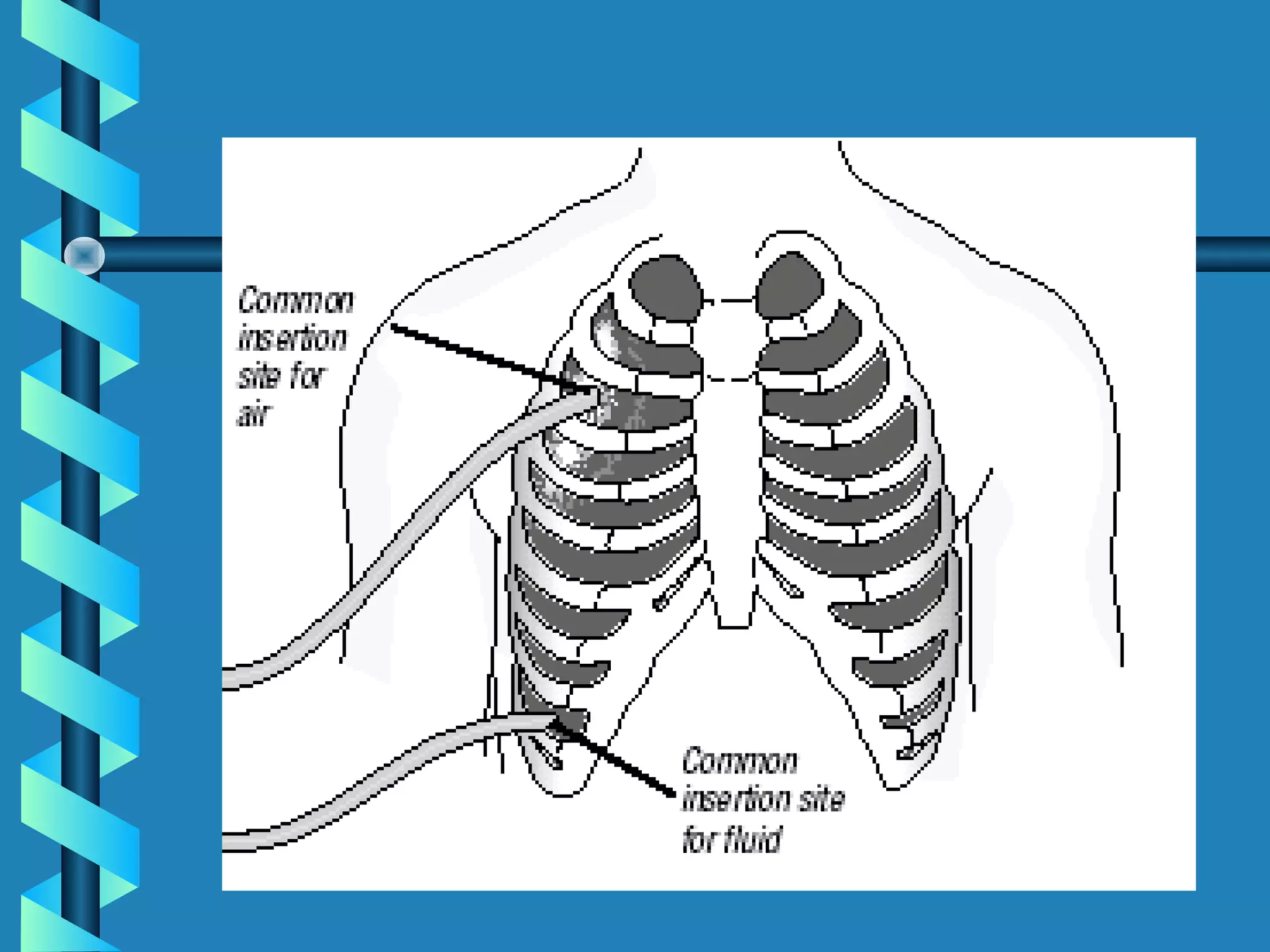 2. chest tube drainage | PPT