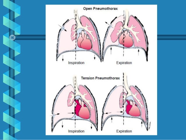 2. chest tube drainage