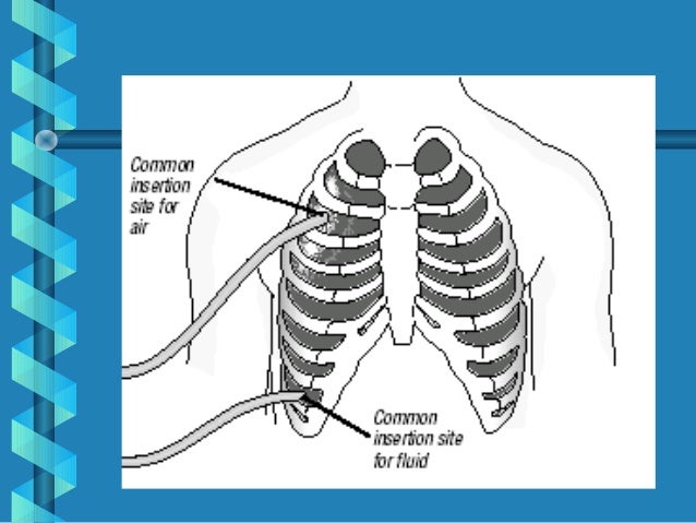 2. chest tube drainage