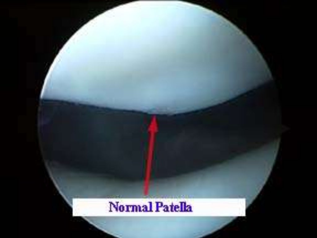 chondromalacia patellae