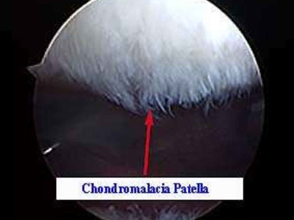 chondromalacia patellae