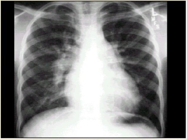 ComunicacióN Interauricular