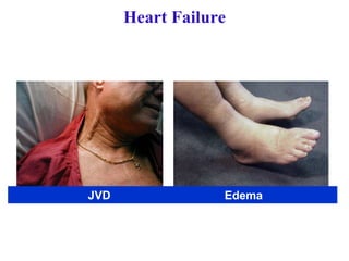 2 dan atar - esc hf guidelines - clinical aspects | PPTX