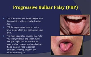 Motor Neuron Diseases | PPTX