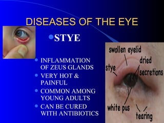 2. diseases of the eyes | PPT