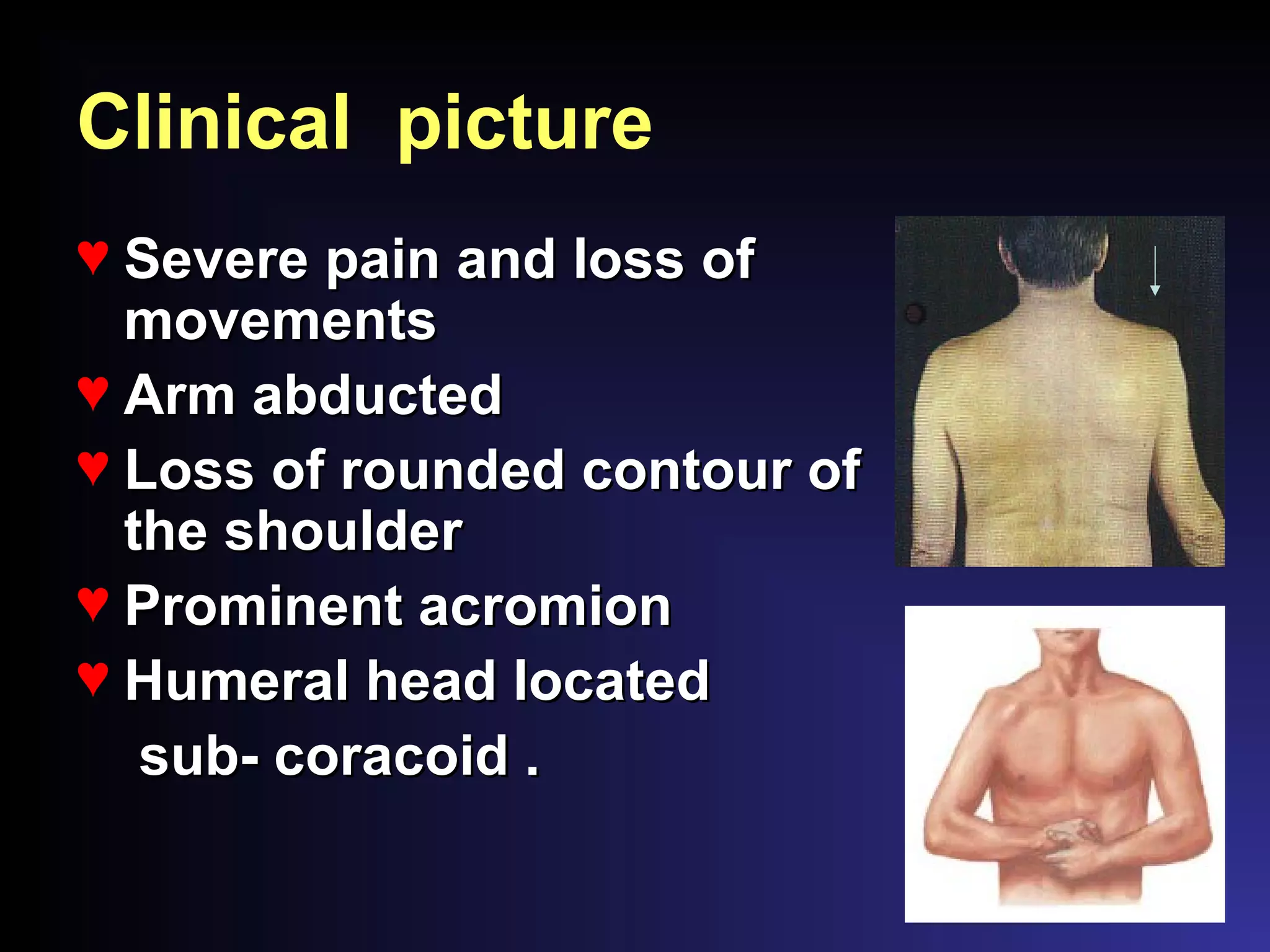 Dislocation of Upper Limb | PPT