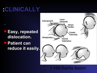 Dislocation of Upper Limb | PPT