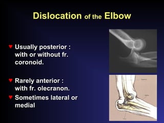 Dislocation of Upper Limb | PPT
