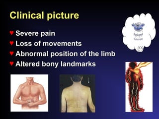 Dislocation of Upper Limb | PPT