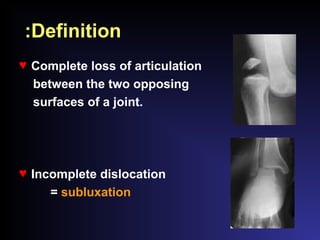 Dislocation of Upper Limb | PPT