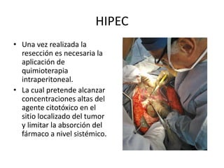2-estadificacion-y-manejo-quirurgico-actual-en-cancer-de (1).pdf