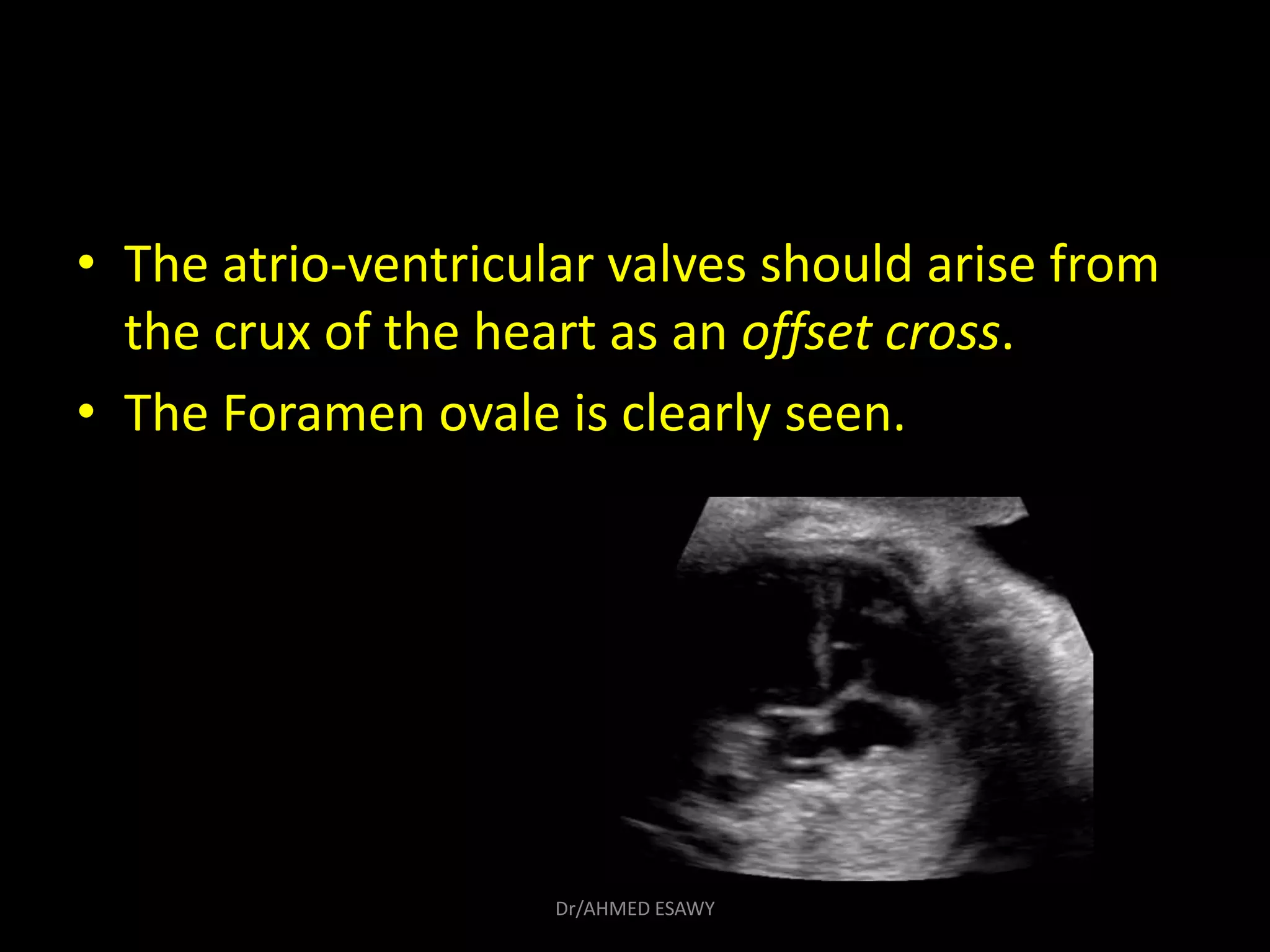 2 fetal echo part 1 Dr Ahmed Esawy | PDF