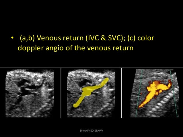 2 fetal echo part 1 Dr Ahmed Esawy