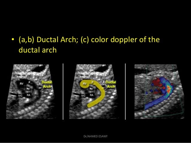 2 fetal echo part 1 Dr Ahmed Esawy