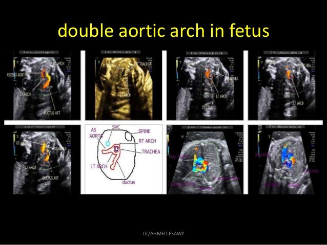 2-Fetal Echo part 2 Dr Ahmed Esawy