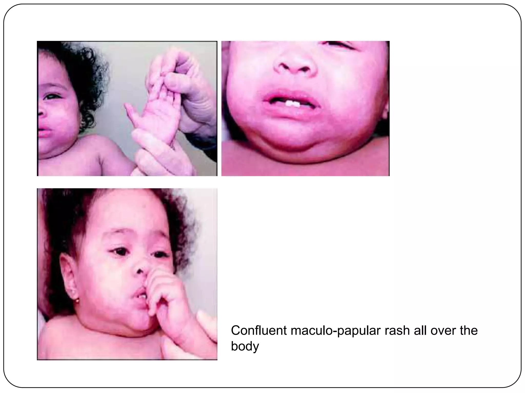 2. fever with rash | PPTX