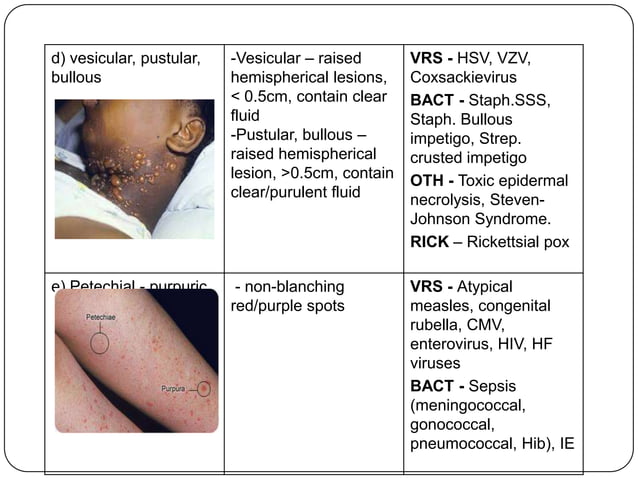 2. fever with rash | PPTX | Infectious Diseases | Diseases and Conditions