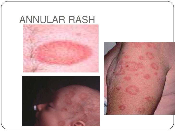 2. fever with rash