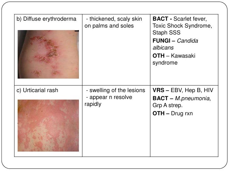 Focal Rash Focal Rash