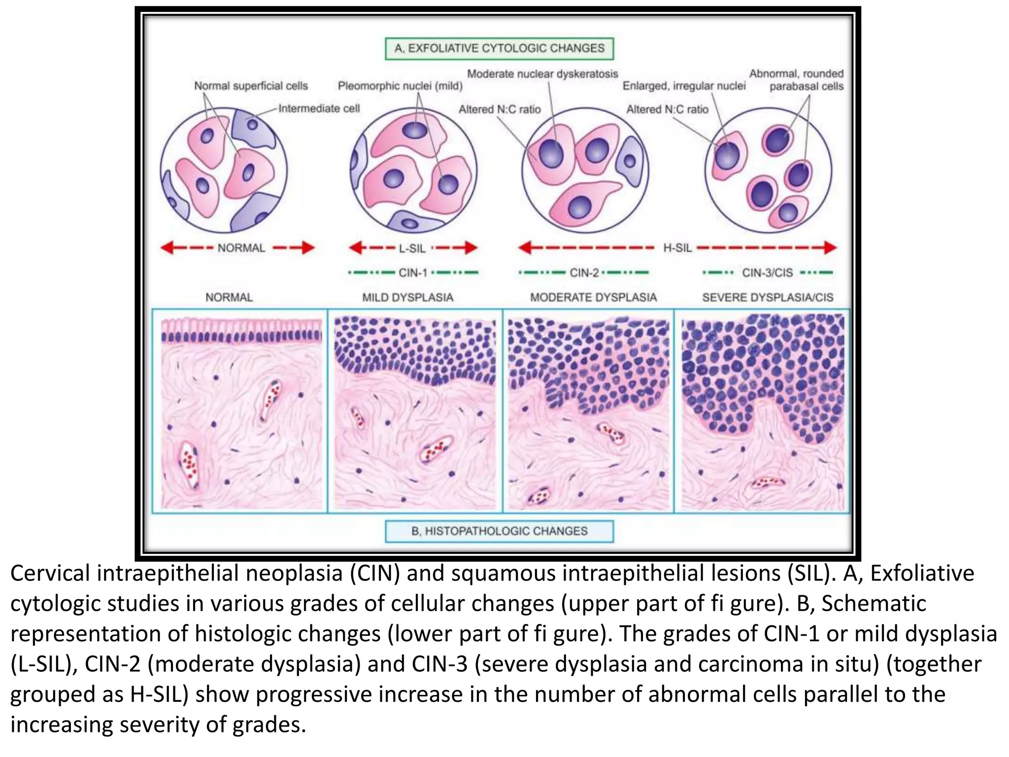 FEMALE GENITAL SYSTEM: CERVIX LESIONS | PPTX