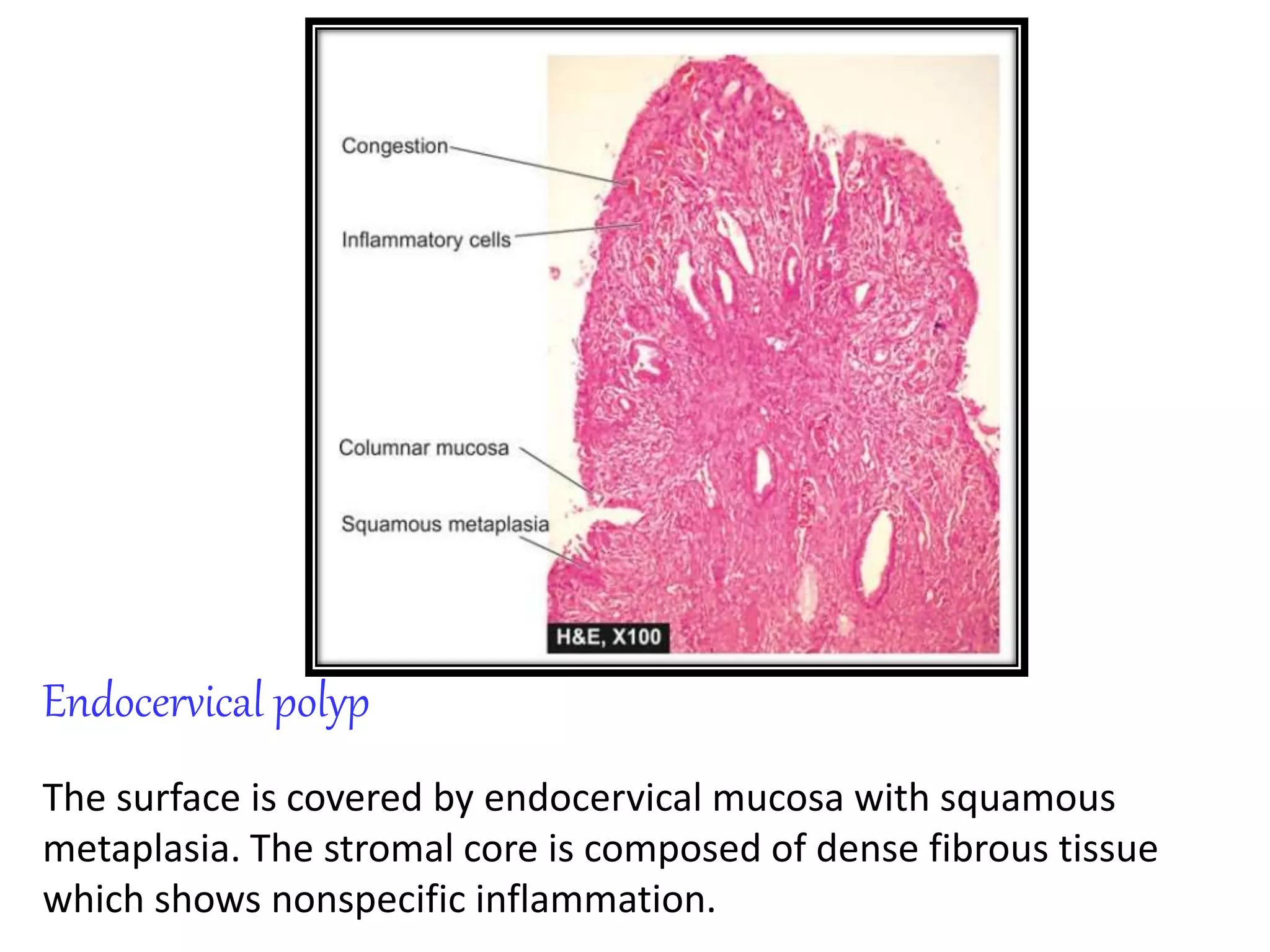 FEMALE GENITAL SYSTEM: CERVIX LESIONS | PPTX