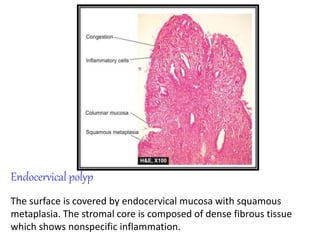 FEMALE GENITAL SYSTEM: CERVIX LESIONS | PPTX