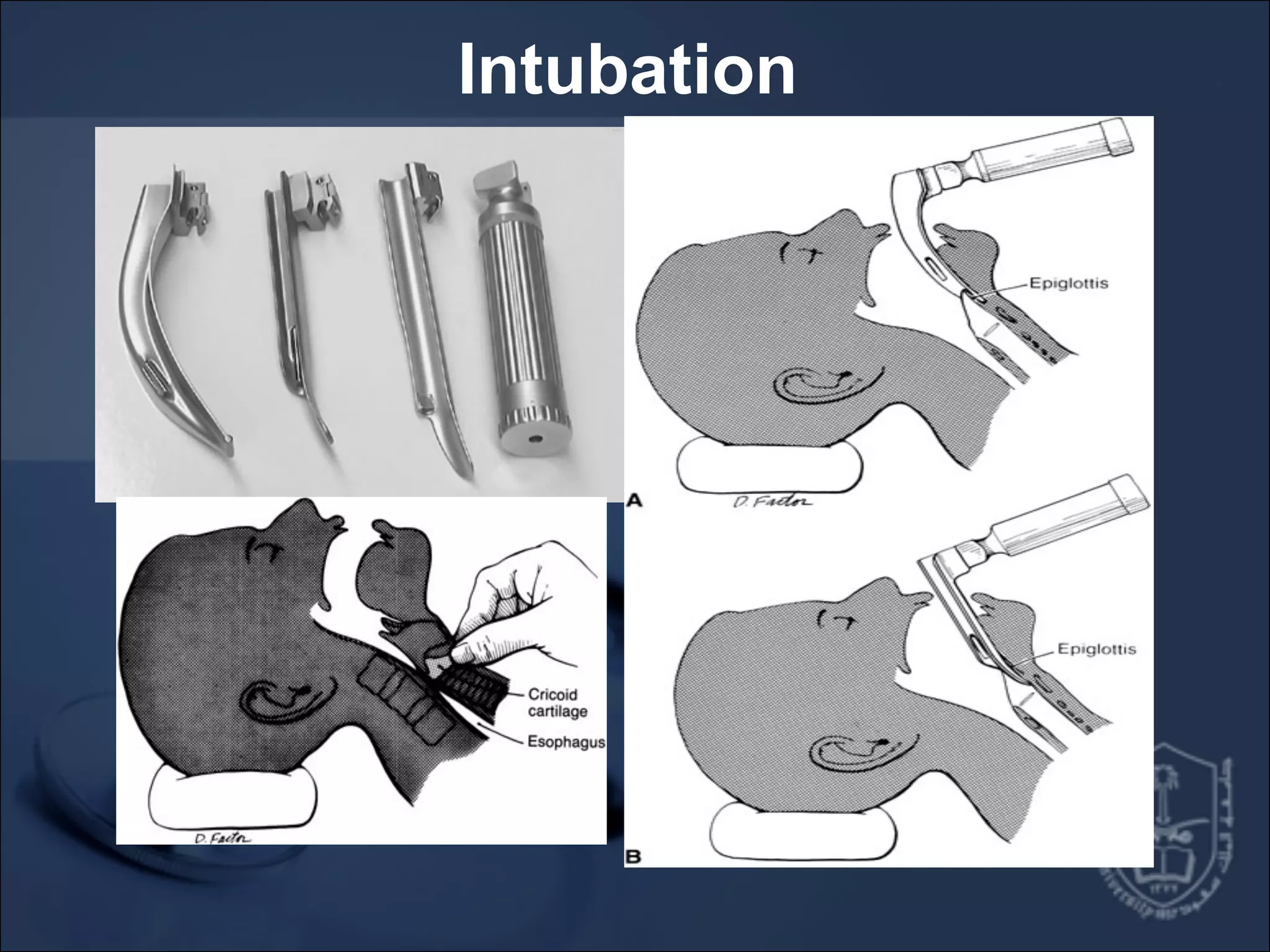 2- General Anaesthesia Technique.pdf