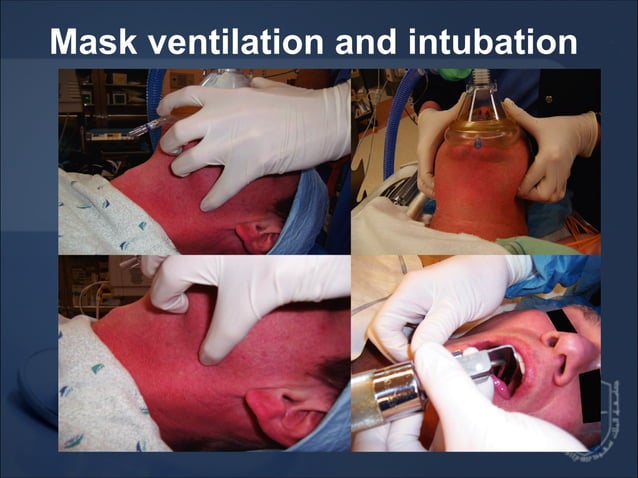 2- General Anaesthesia Technique.pdf