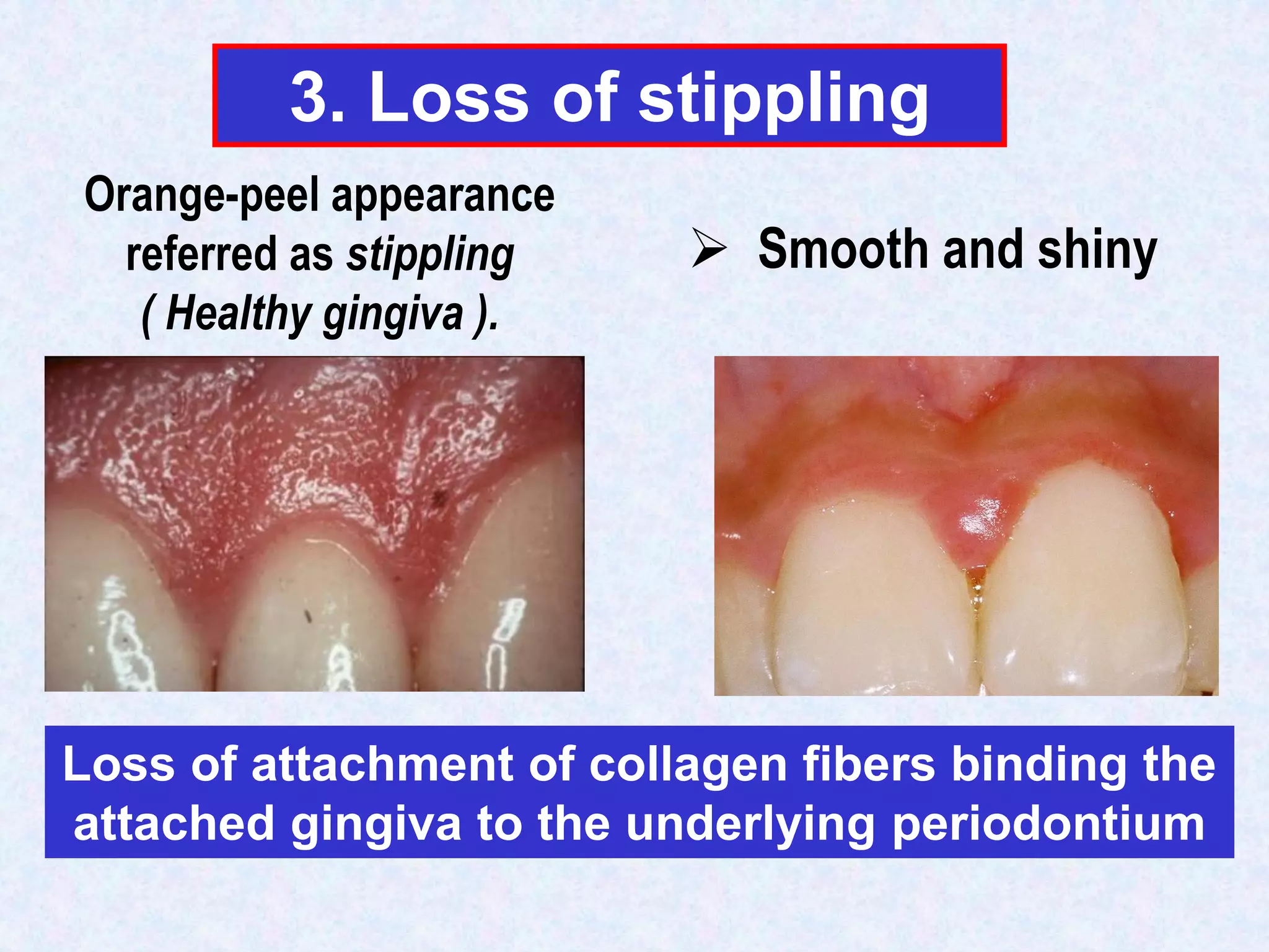 2- Gingivitis and periodontitis.pdf