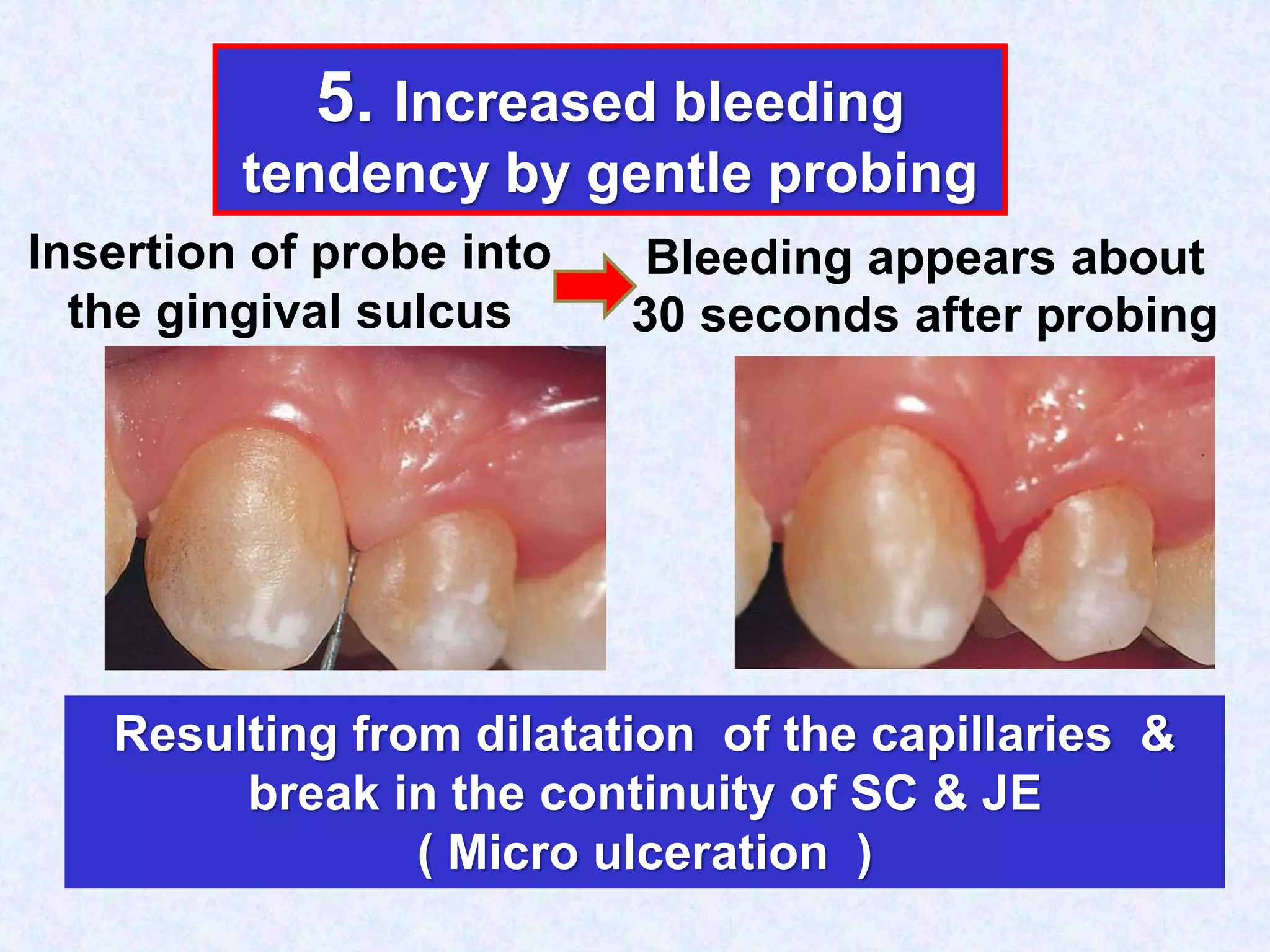 2- Gingivitis and periodontitis.pdf