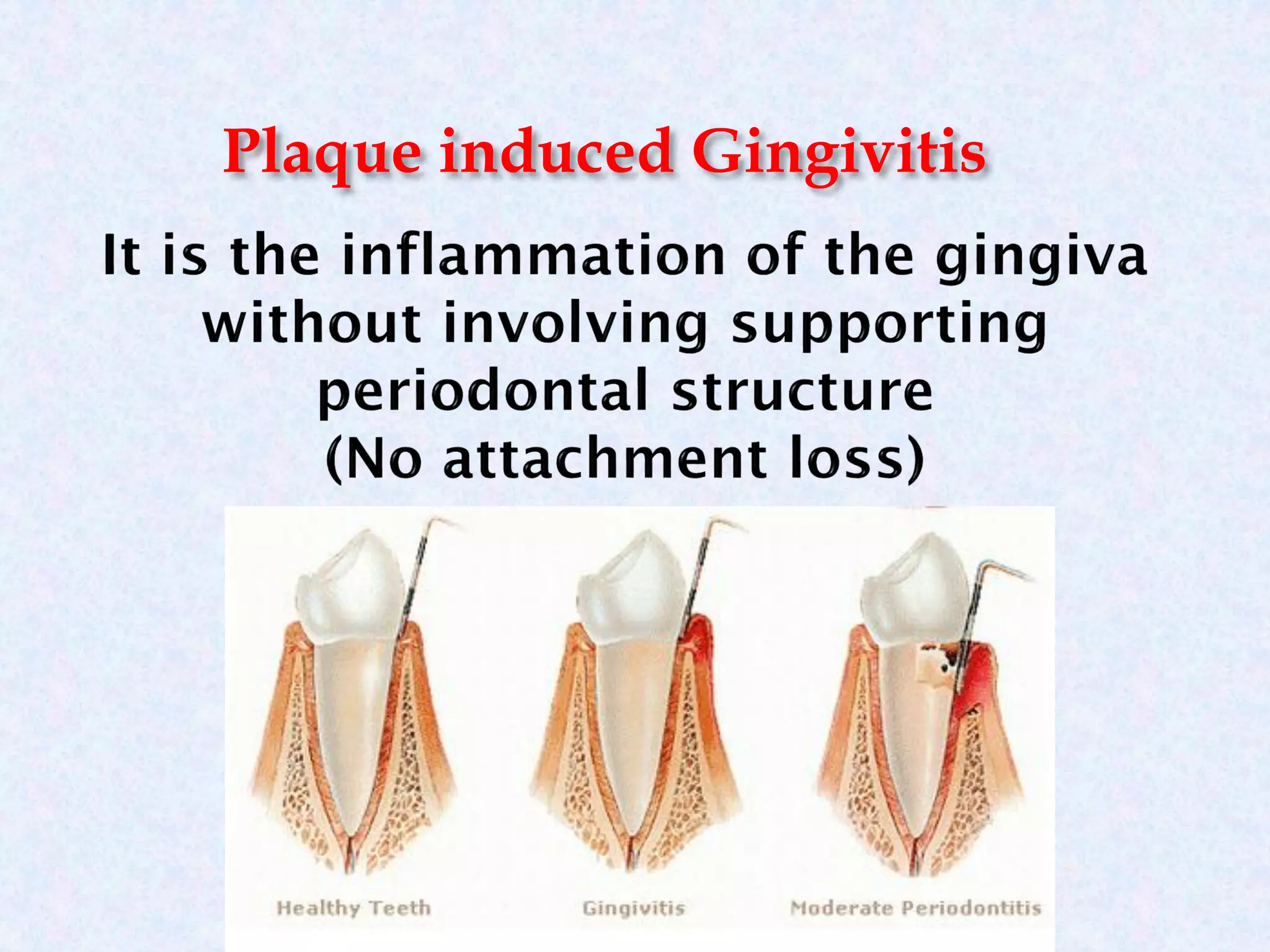 2- Gingivitis and periodontitis.pdf