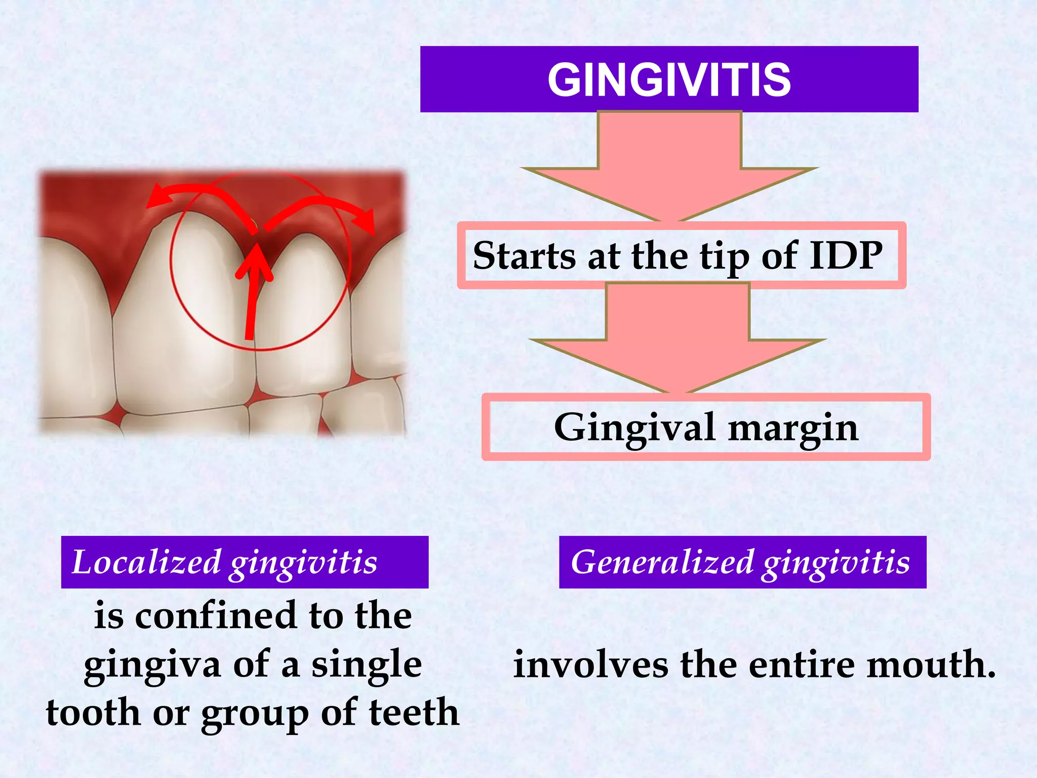 2- Gingivitis and periodontitis.pdf