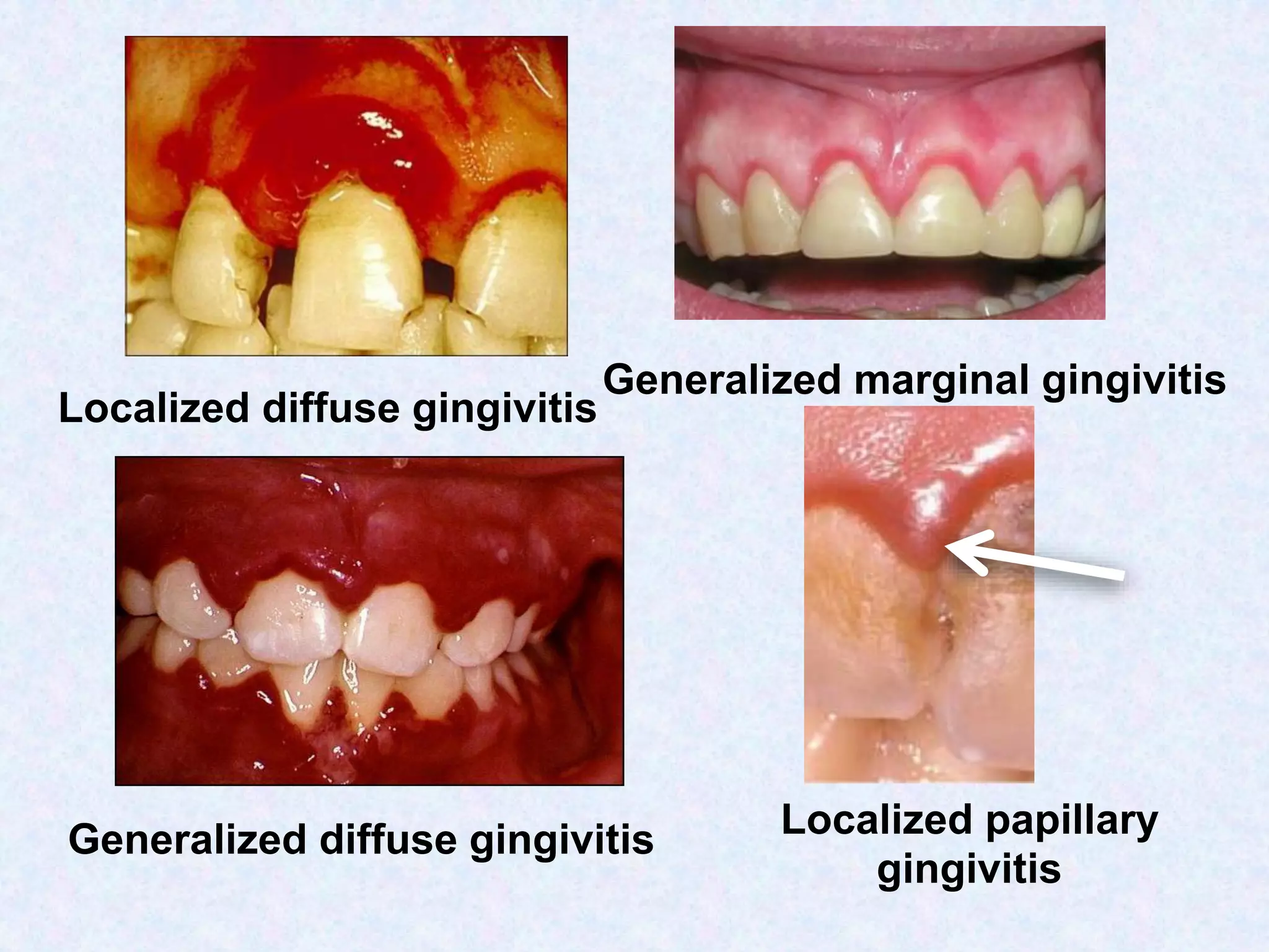 2- Gingivitis and periodontitis.pdf