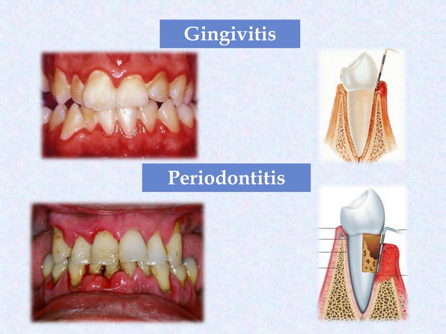2- Gingivitis and periodontitis.pdf