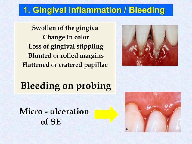 2- Gingivitis and periodontitis.pdf