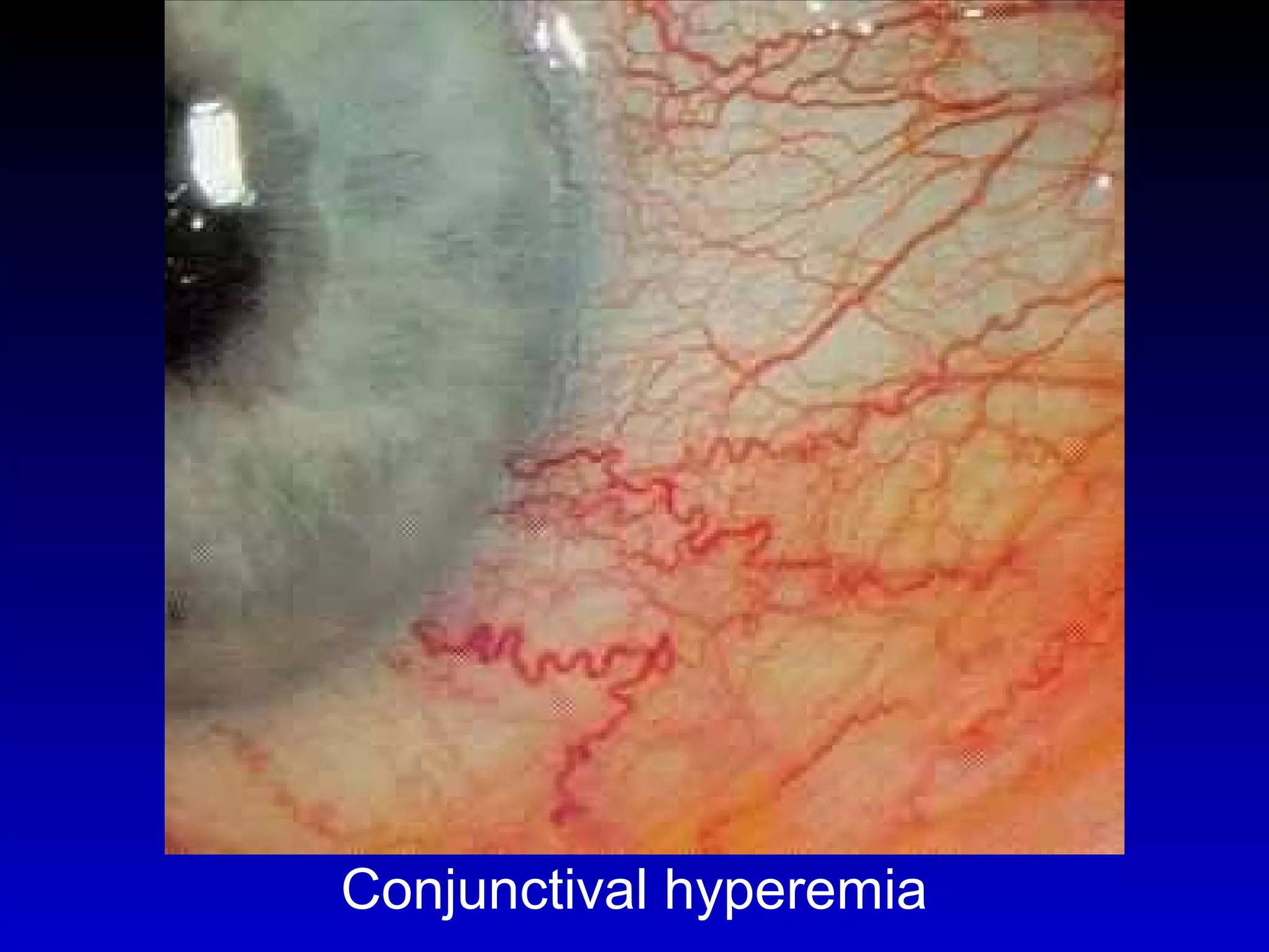 2 hyperemia-congestion | PPT