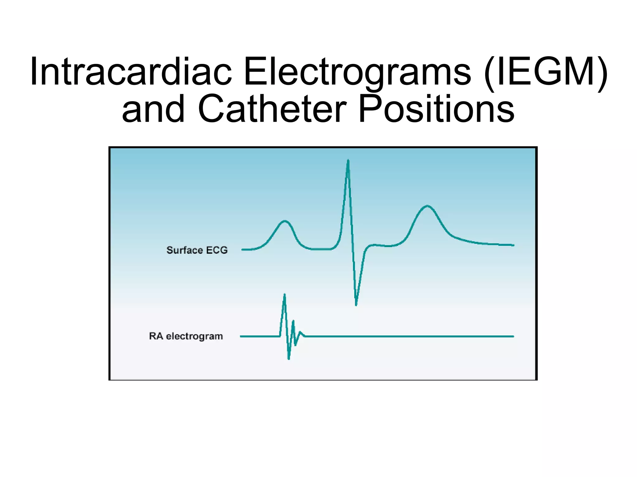 Intracardiac Electrograms | PDF