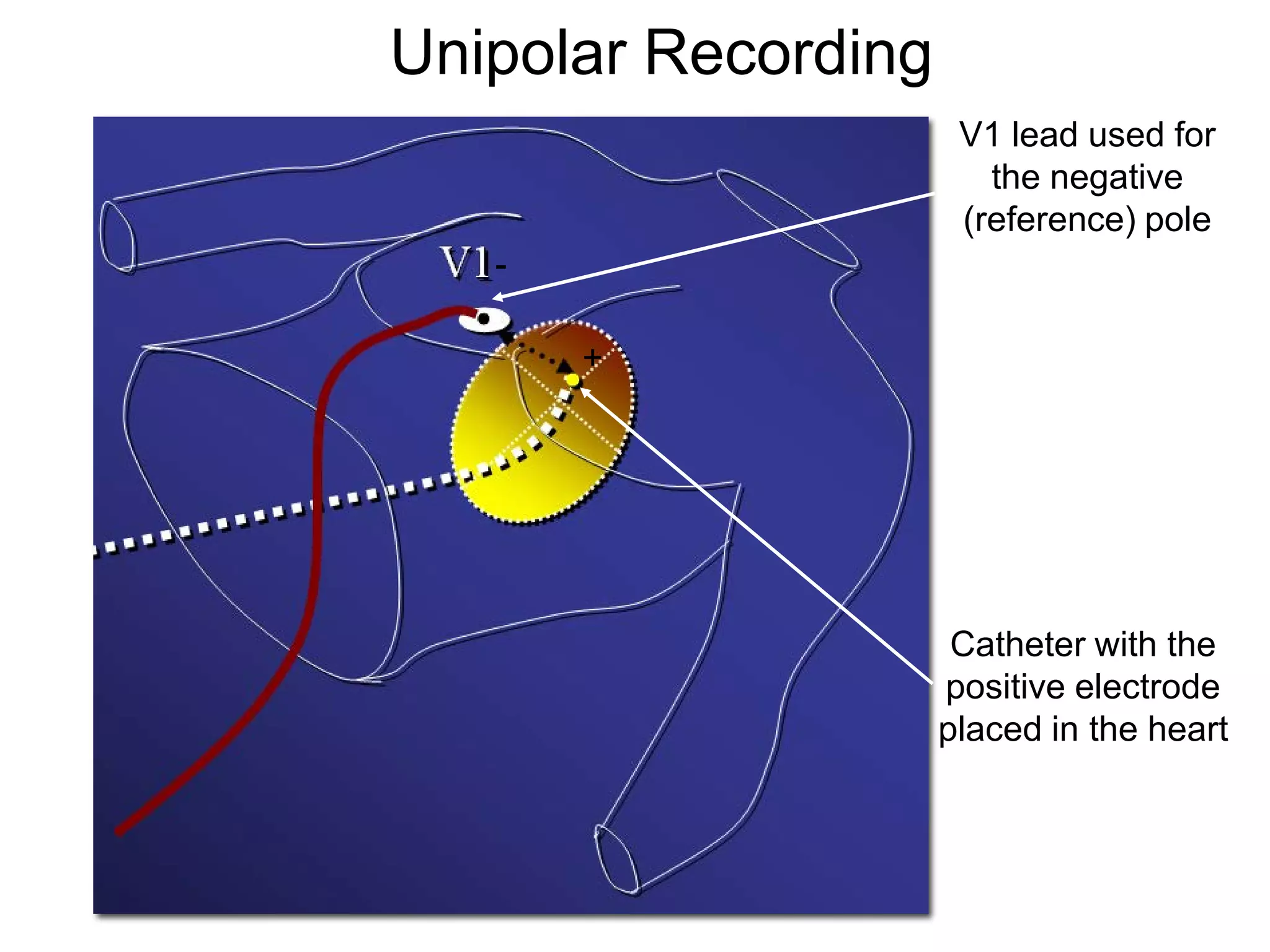 Intracardiac Electrograms | PDF