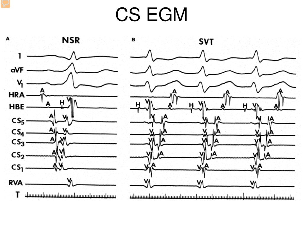 Intracardiac Electrograms