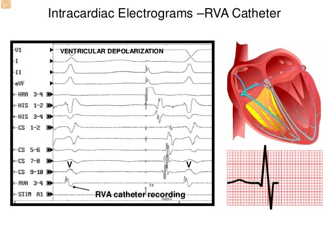 Intracardiac Electrograms