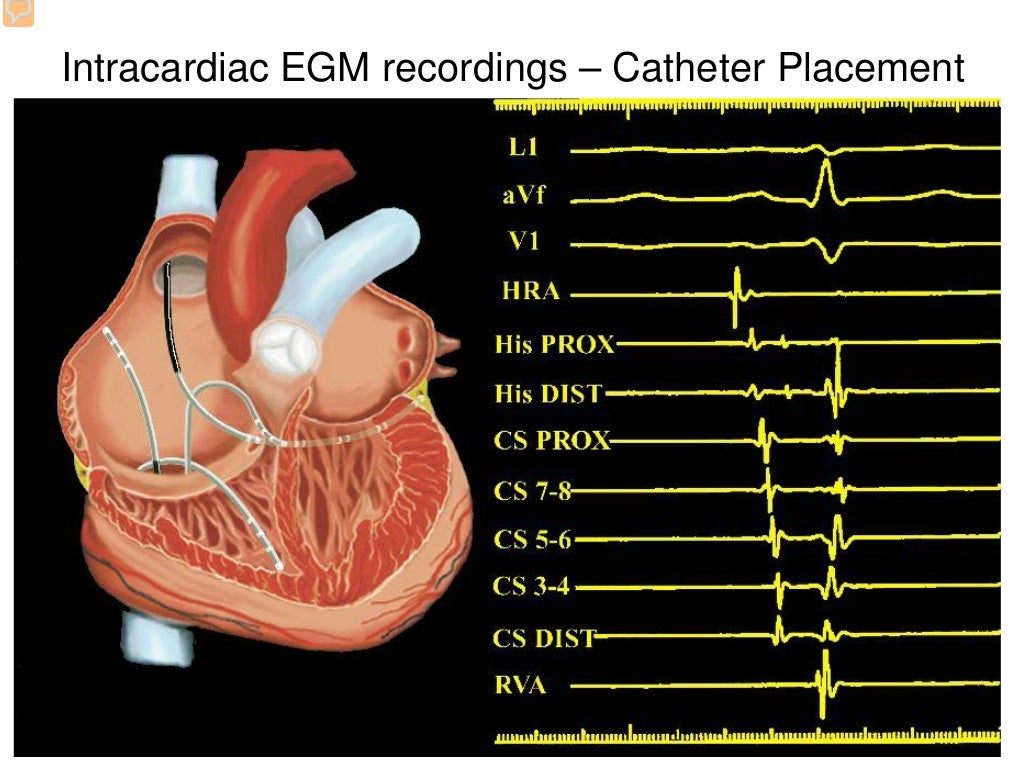 Intracardiac Electrograms