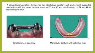 2-Jc Stabilizing mandibular dentures jc 2.pptx