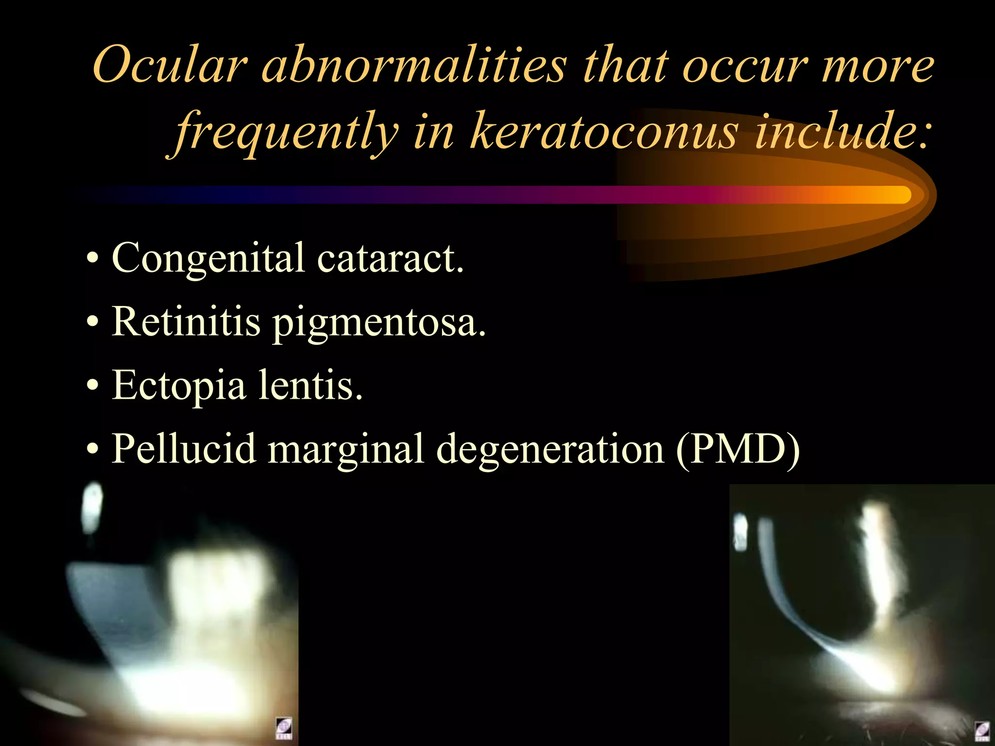 Keratoconus and Contact lenses | PPTX