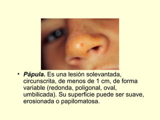 2 lesiones elementales | PPT